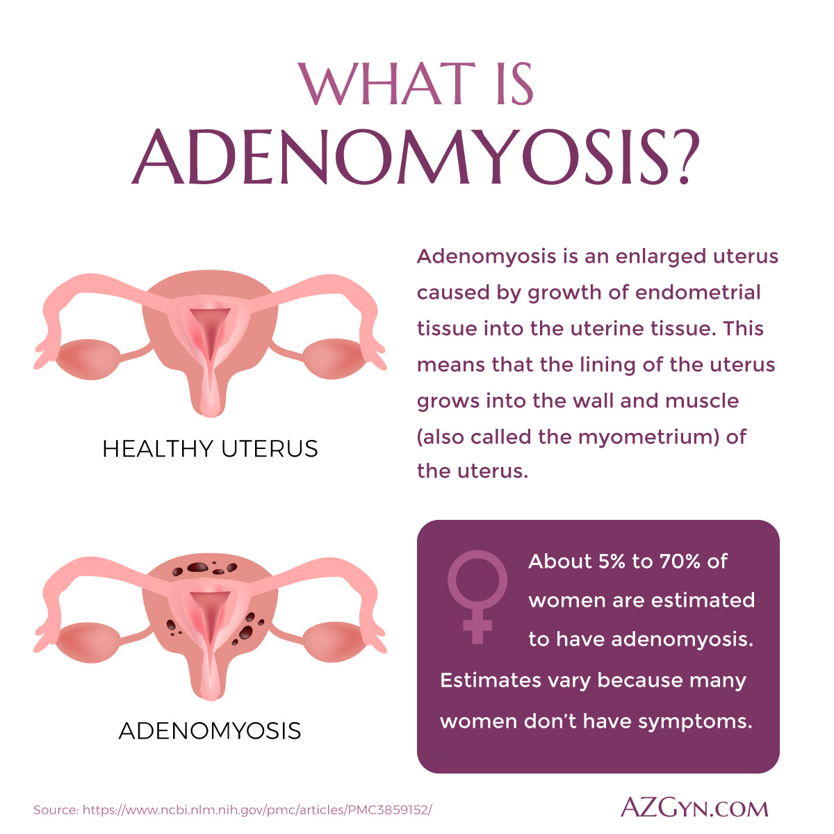 Adenomyosis Risk Factors Adenomyosis Causes And Symptoms